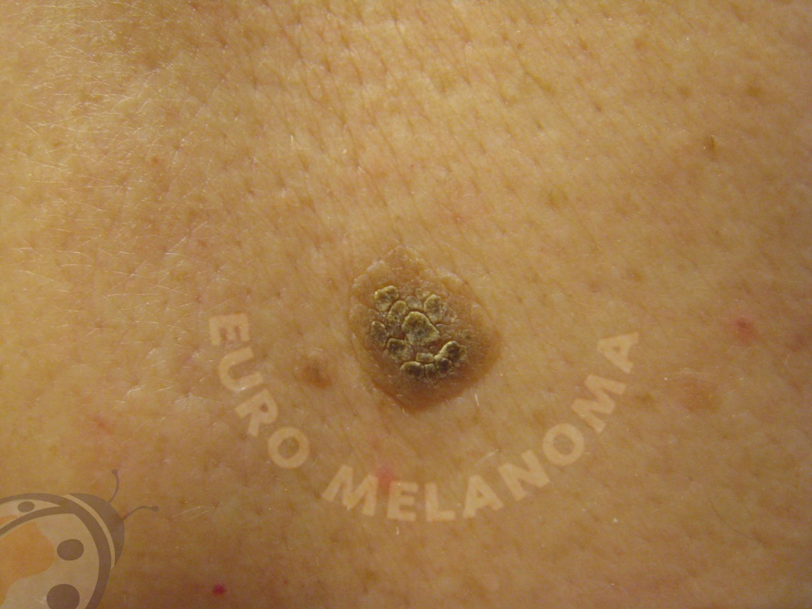 Seborrheic keratosis - Euromelanoma